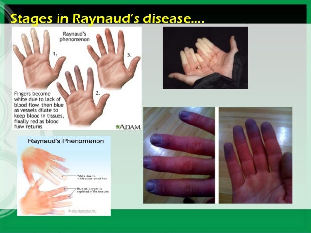 perpheral vascular disease & gangrene examination