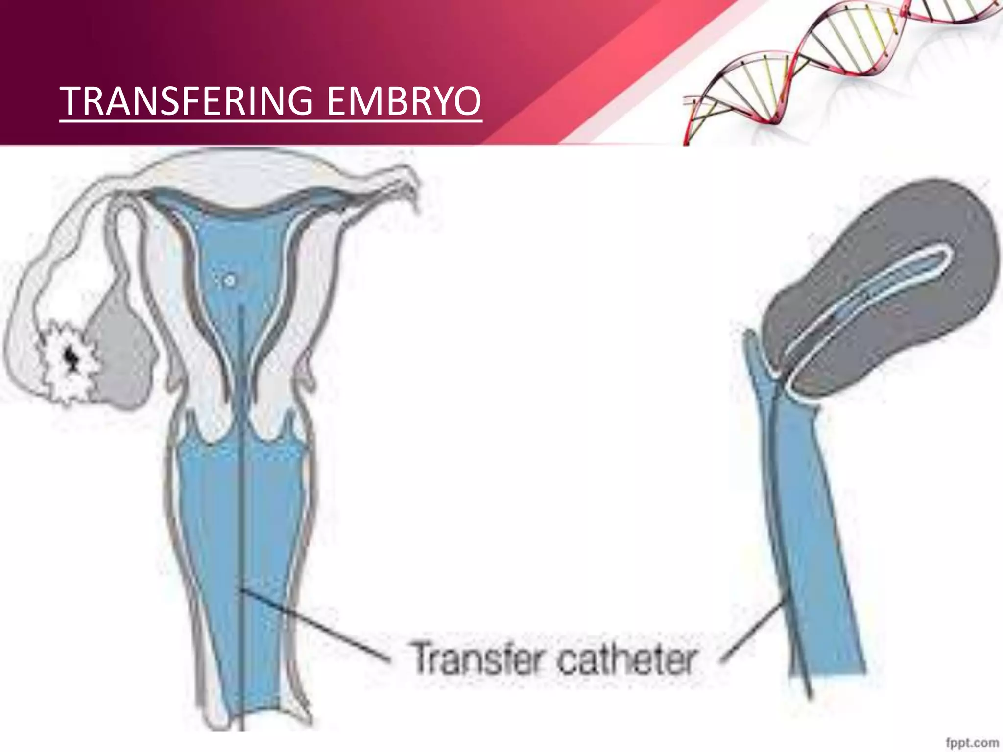 INVITRO FERTILIZATION - EMBRYO TRANSFER | PPTX