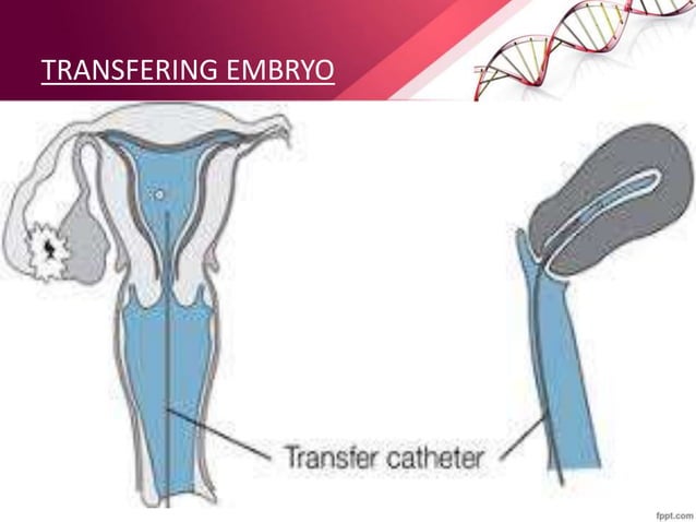 INVITRO FERTILIZATION - EMBRYO TRANSFER | PPTX