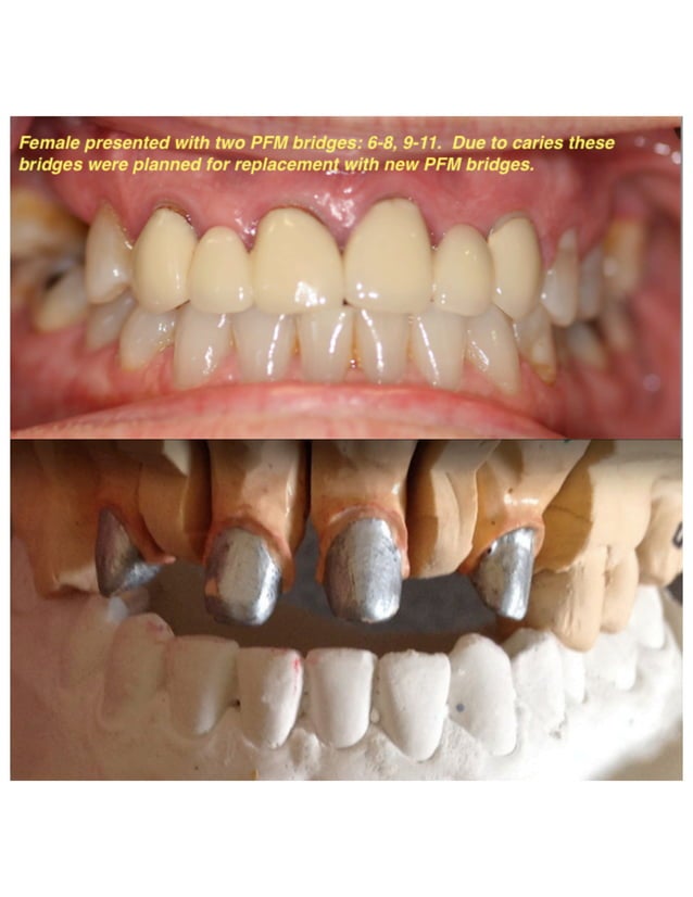 PFM Bridge Case 1 | PDF