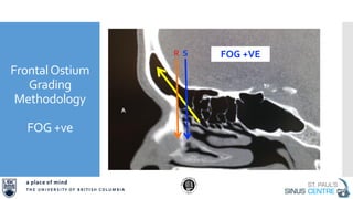 Award-winning New CT grading system for preoperative Endoscopic Frontal ...