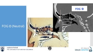 Award-winning New CT grading system for preoperative Endoscopic Frontal ...