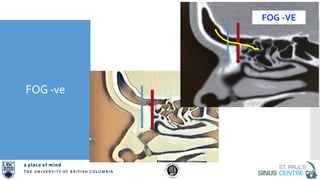 Award-winning New CT grading system for preoperative Endoscopic Frontal ...