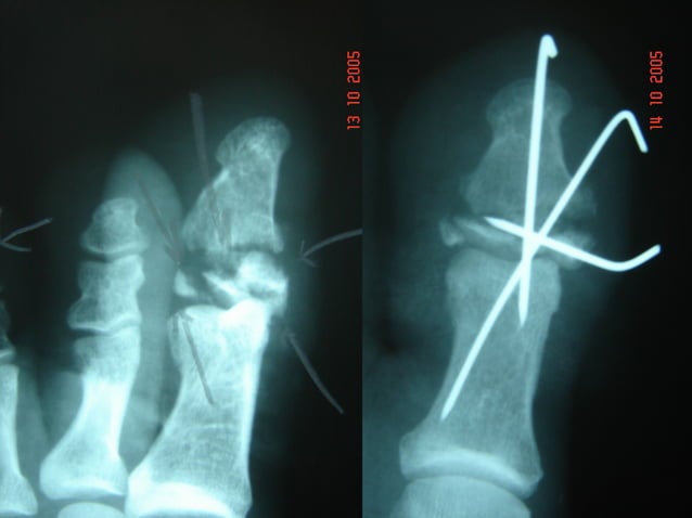 1foot fx orif k wire | PPT