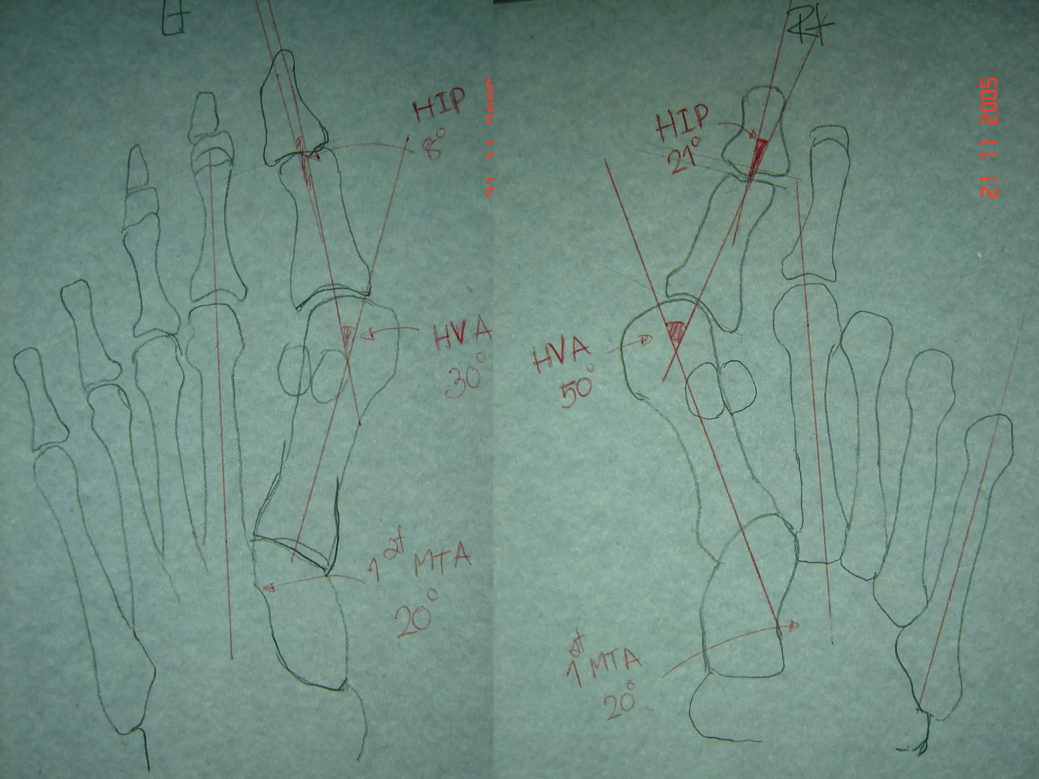 1foot hallus valgus 2 | PPT
