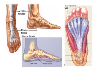 1foot plantar fasiitis | PPT