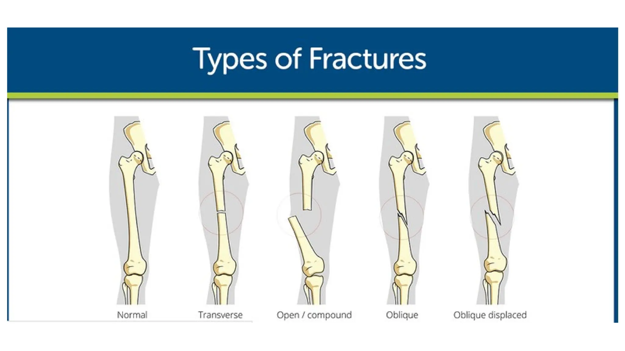 The fractures in the children and the types | PPTX