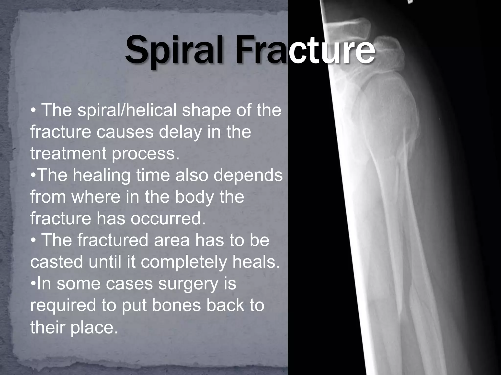 3 bone fractures | PPT