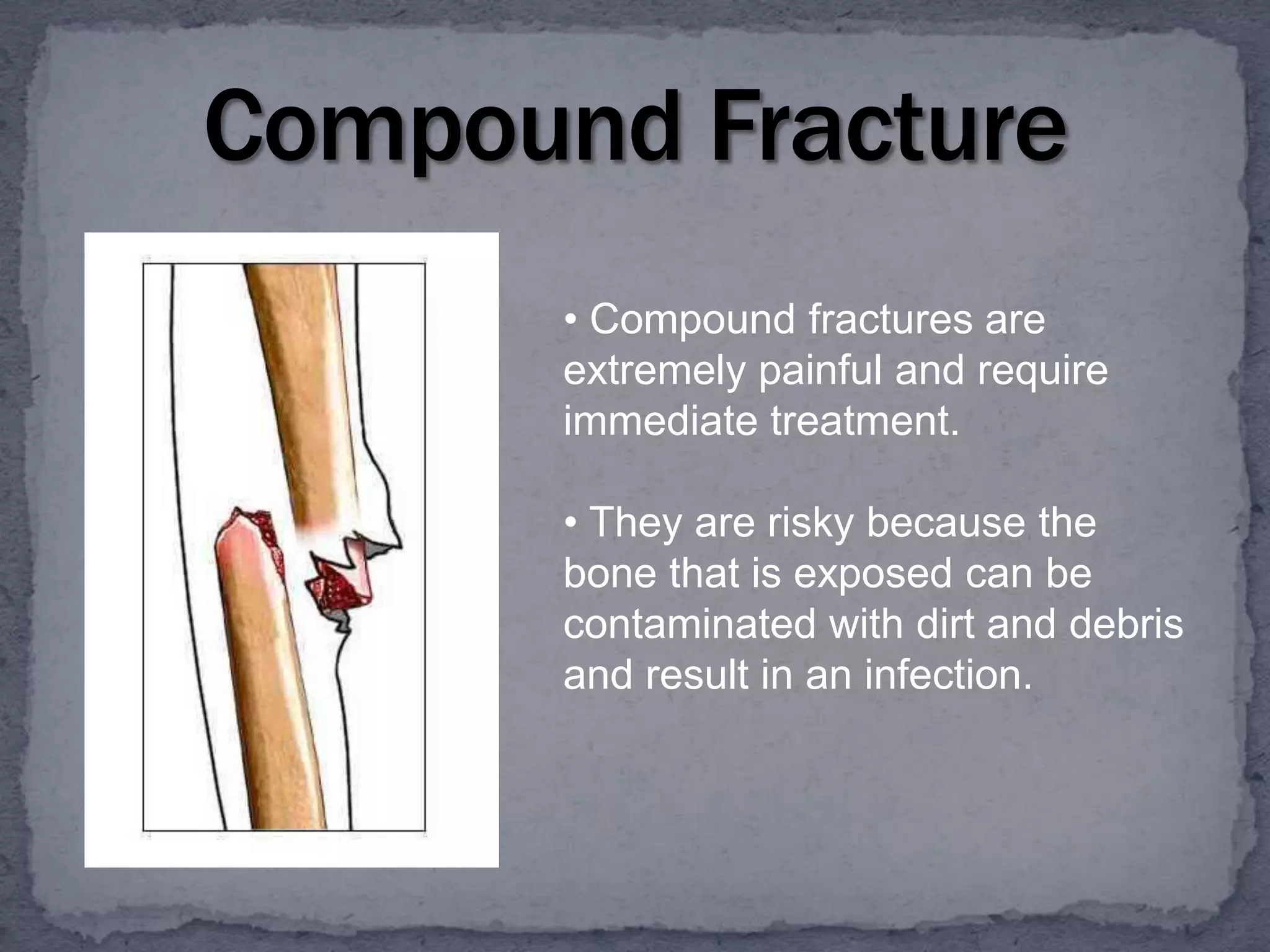 3 bone fractures | PPT