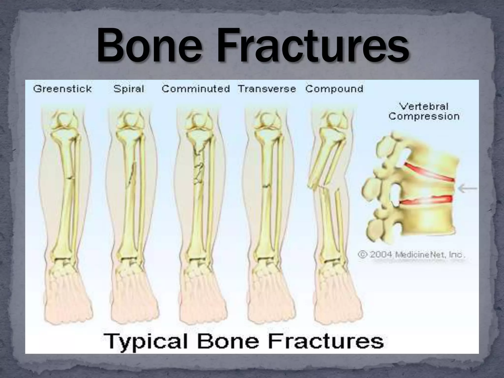 3 bone fractures | PPT