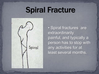 3 bone fractures | PPTX