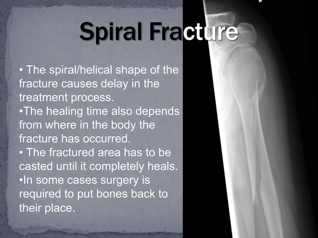 3 bone fractures | PPT