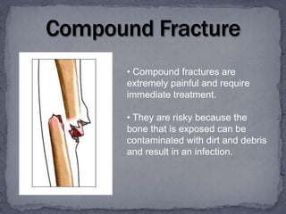 3 bone fractures | PPT