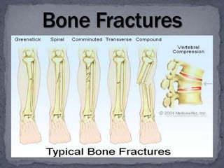 3 bone fractures | PPT