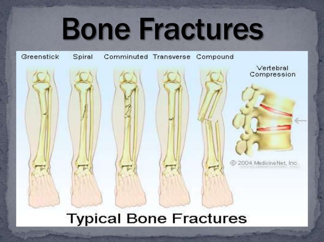 3 bone fractures | PPT