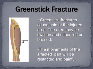 3 bone fractures | PPT