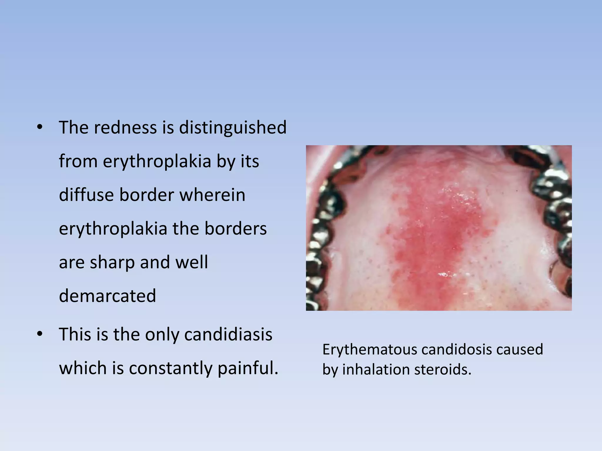 1 FUNGAL DISEASES OF ORAL CAVITY.pptx