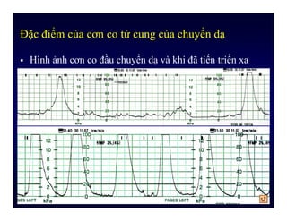 SINH LÝ CHUYỂN DẠ | PDF