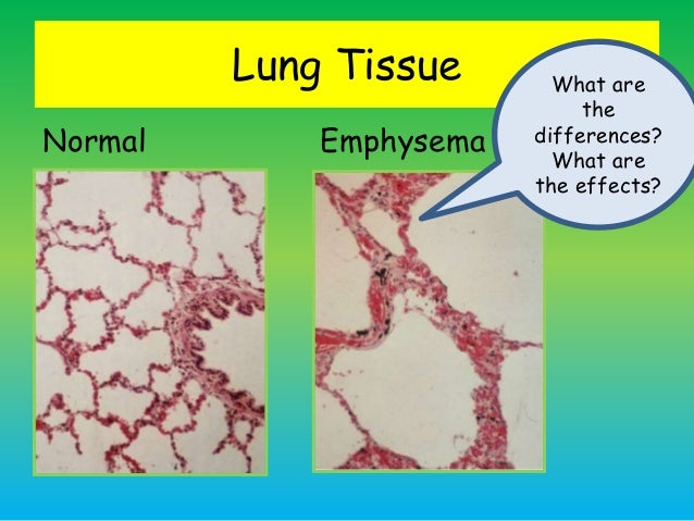 Emphysema Lung Vs Normal Lung