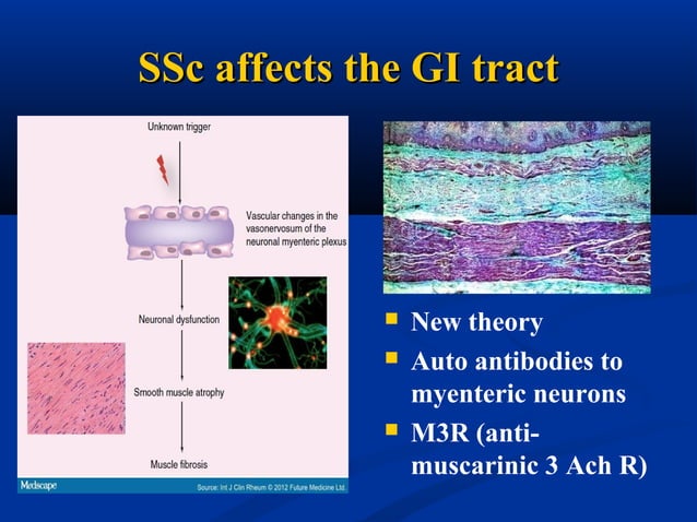 1 gastrointestinal manifestations of systemic sclerosis | PPT ...
