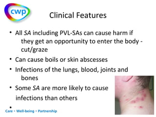 Panton Valentine Leukocidin Staphylococcus aureus (PVL-SA) | ODP