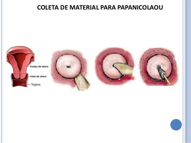 A técnica citológica de papanicolaou