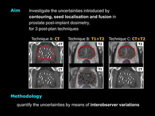 NY Prostate Cancer Conference - P. Hoskin - Session 7: How the ...