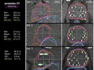 NY Prostate Cancer Conference - P. Hoskin - Session 7: How the ...