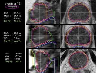 NY Prostate Cancer Conference - P. Hoskin - Session 7: How the ...