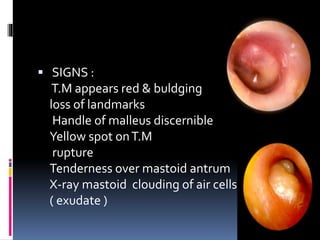 1 hour otitis media ,,.pptx