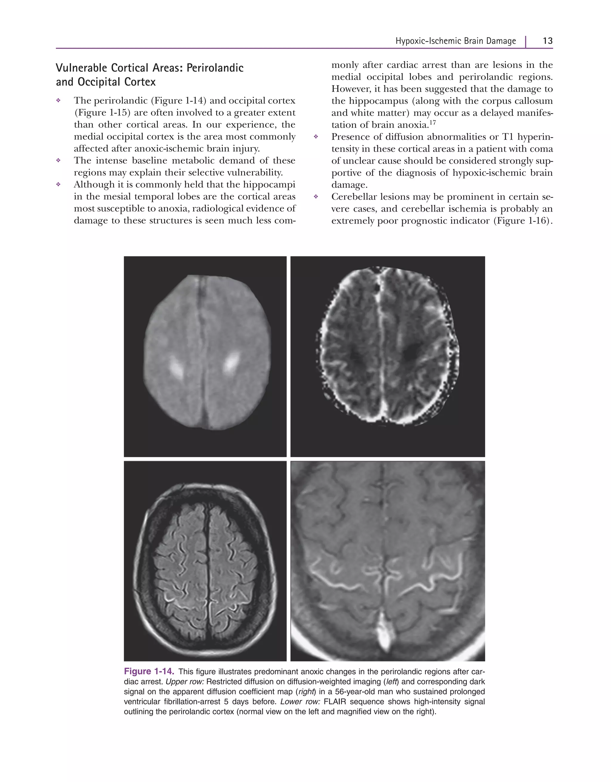 1 hypoxic ischemic brain damage | PDF
