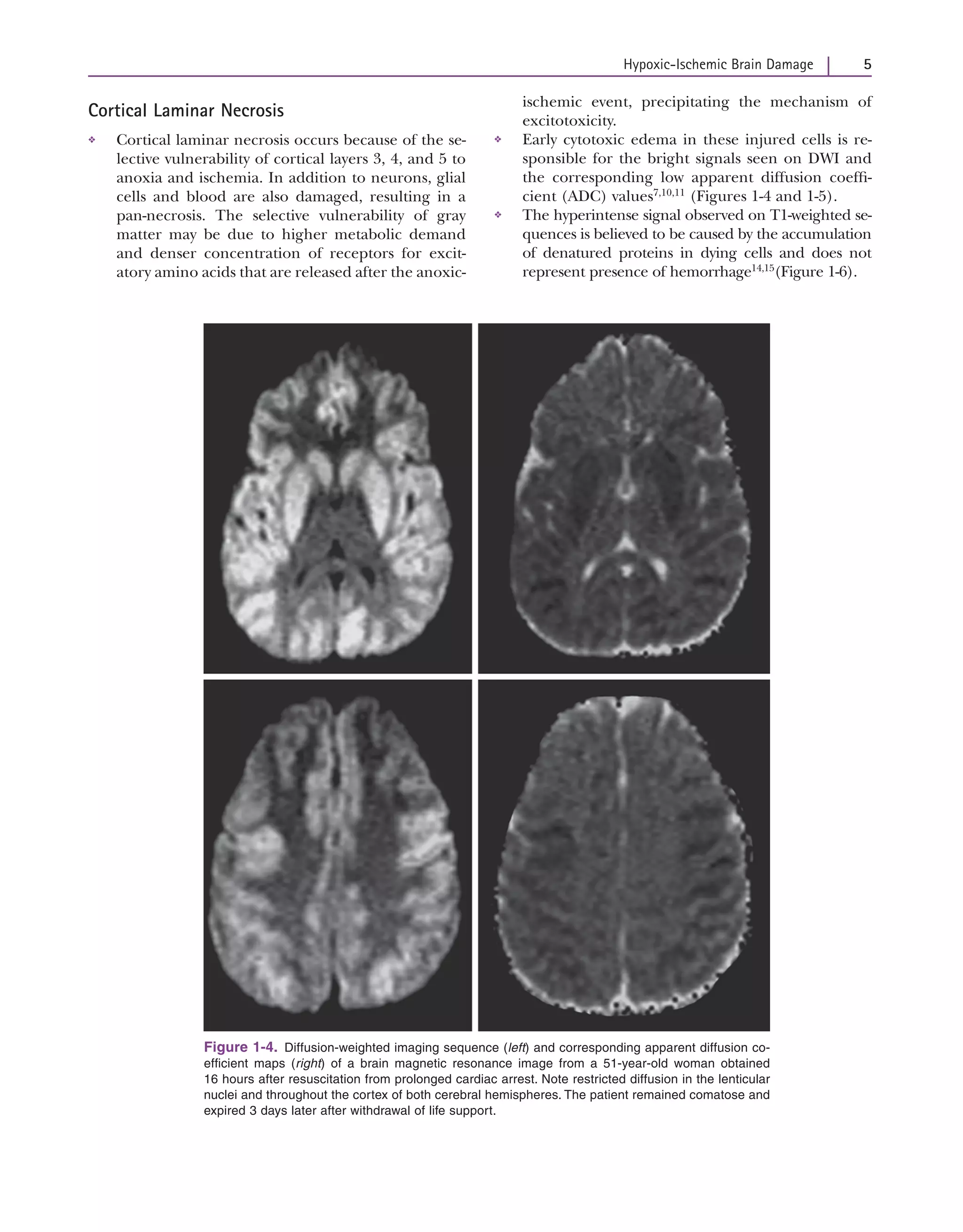 1 hypoxic ischemic brain damage | PDF