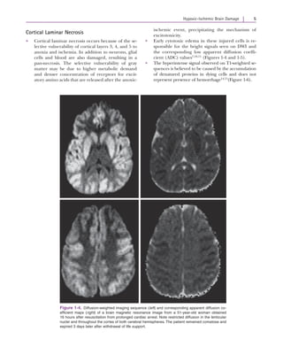 1 hypoxic ischemic brain damage | PDF
