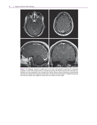 1 hypoxic ischemic brain damage | PDF