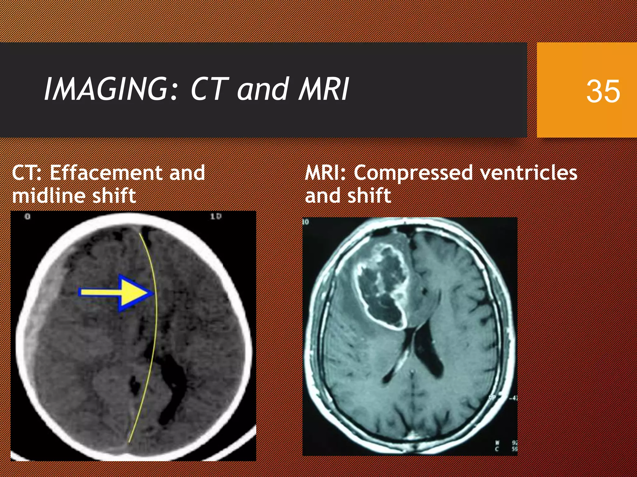 I LOVE NEUROSURGERY INITIATIVE: Increased Intracranial Pressure | PPT