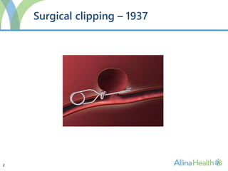 Endovascular treatment of brain aneurysms: Beyond coiling | PPTX
