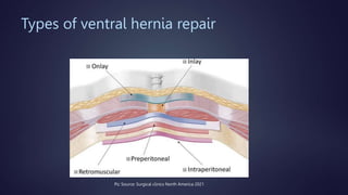 1 IPOM and extraperitoneal techs.pptx