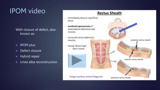 1 IPOM and extraperitoneal techs.pptx
