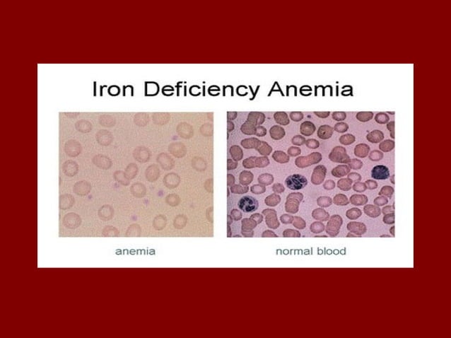 iron & b12 deficiency anemia | PPT