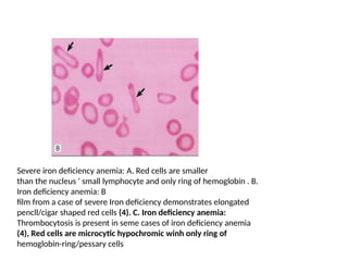 1 IRON DEFICIENCY ANAEMIA.pptx134467788 | PPT