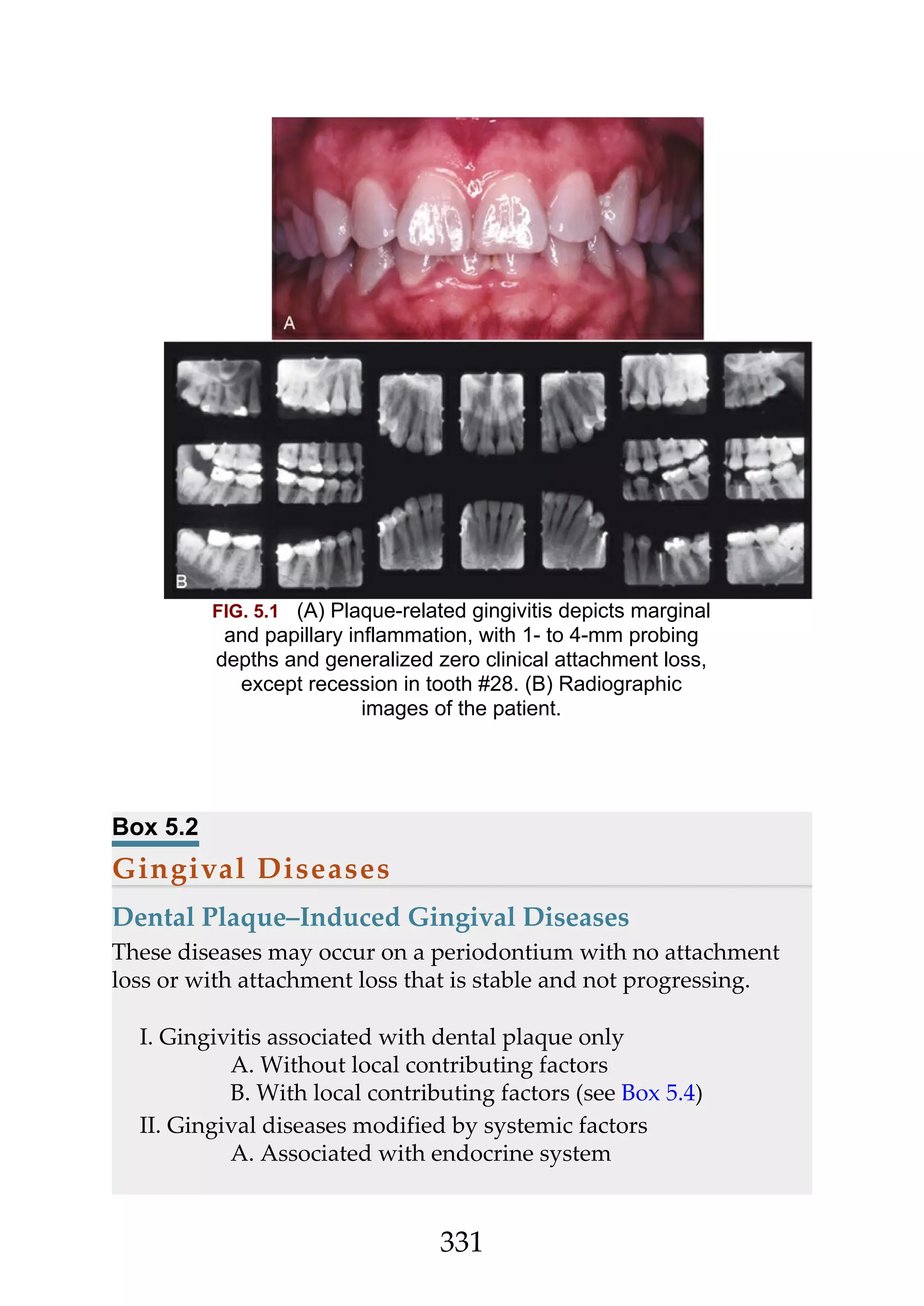 1, Klasifikasi Newman and Carranza's Clinical Periodontology E-Book.pdf