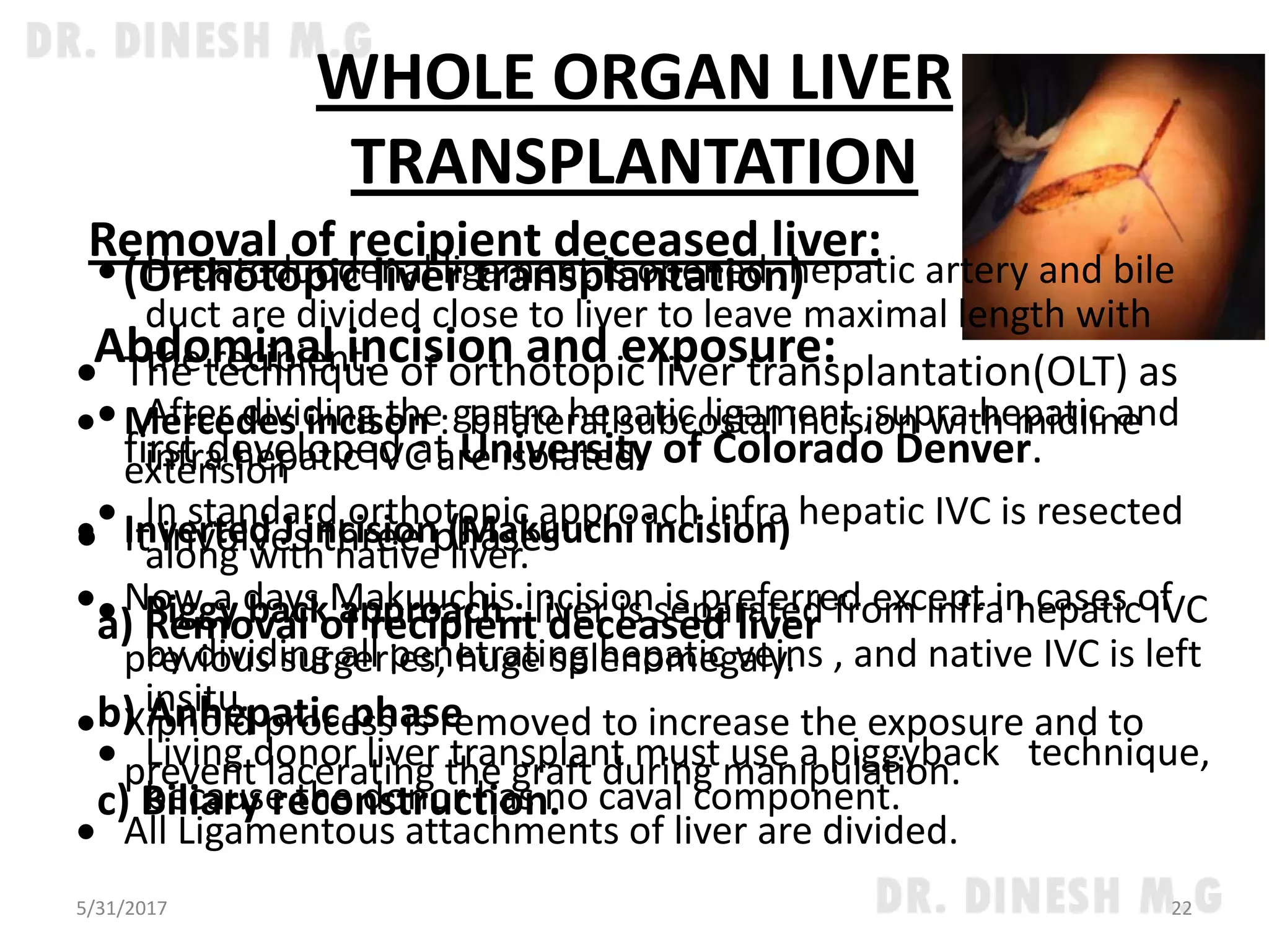Lliver Transplantaion | PDF