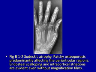 1 localized osteoporosis CLINICAL IMAGAGING AN ATLAS OF DIFFERENTIAL ...