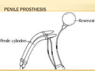 1 male infertility and impotence | PPT