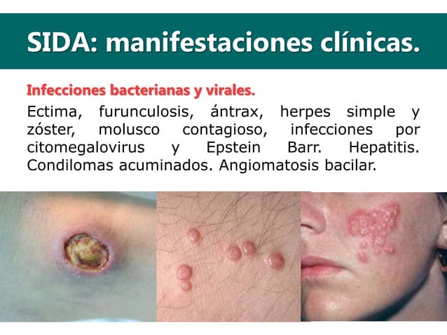 Manifestaciones cutáneas del vih