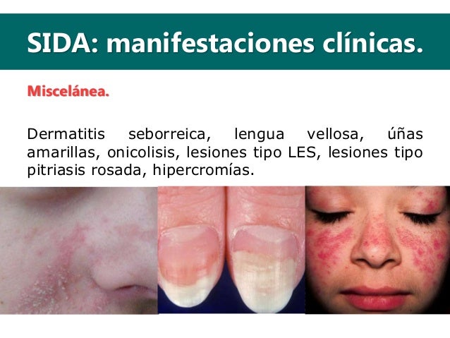 Manifestaciones cutáneas del vih