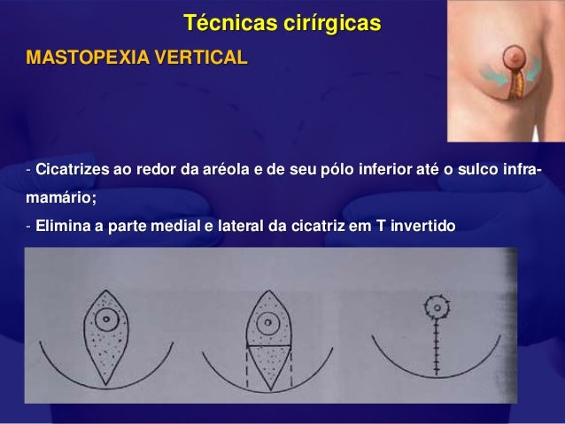 1 Mastoplastia E Mastopexia