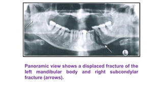 Lecture 1 maxillofacial trauma | PPTX