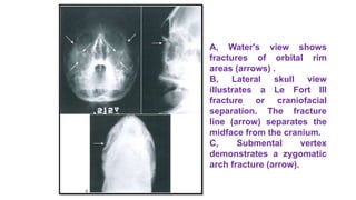 Lecture 1 maxillofacial trauma | PPTX