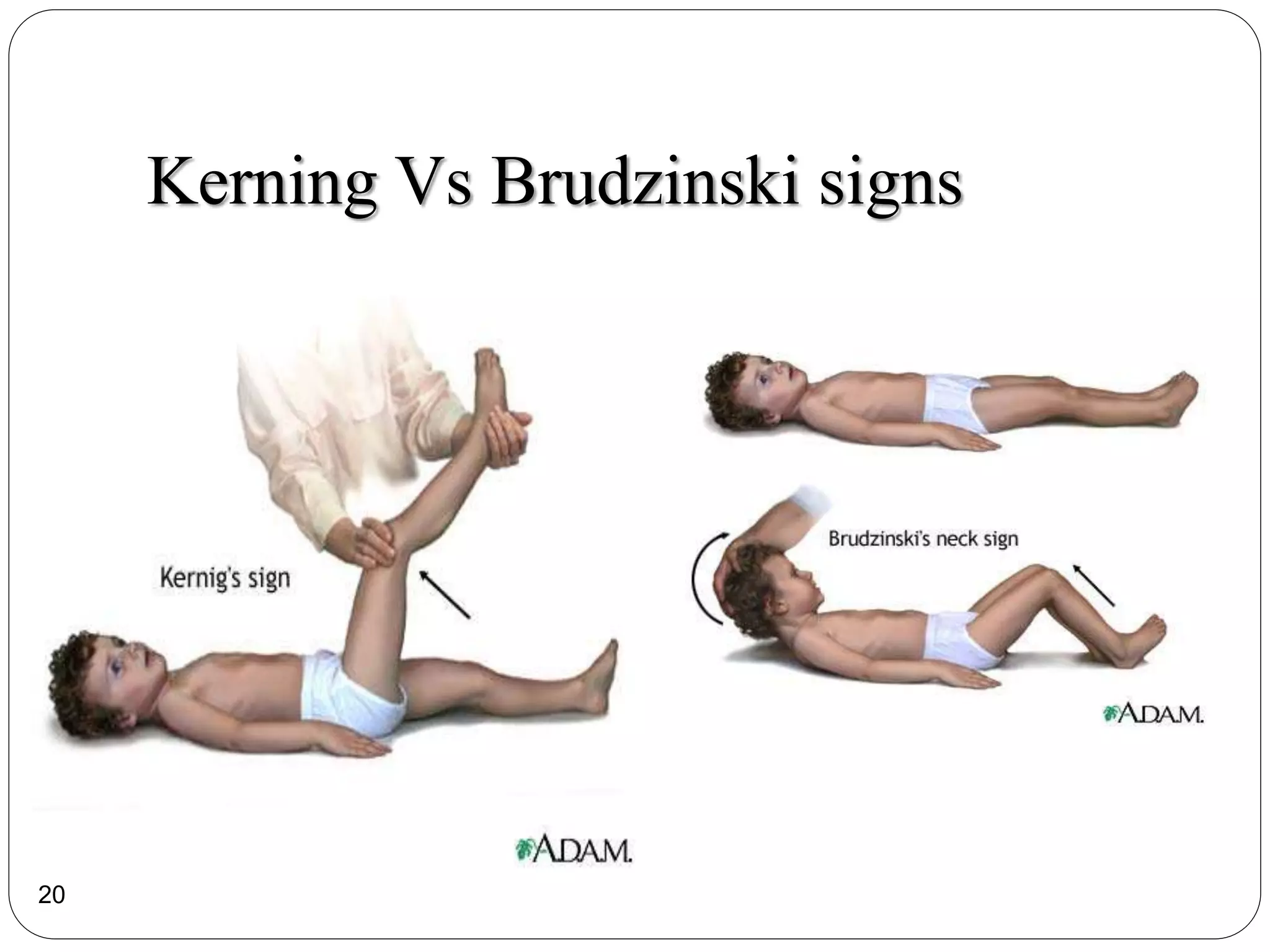 1 Meningitis in children.ppt 44$.ppt